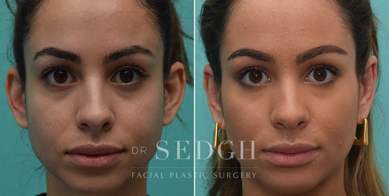 Ear Pinning Surgery Before and After Photos | Dr. Sedgh