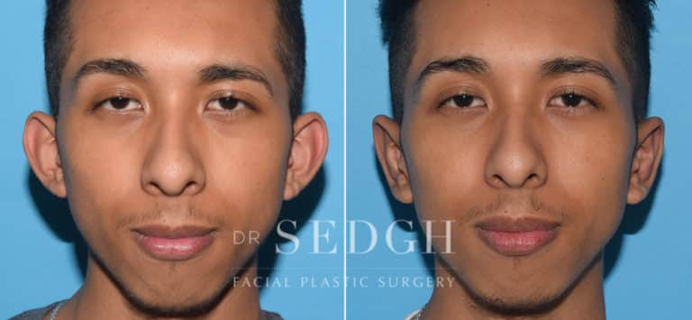Ear Pinning Surgery Before and After Photos | Dr. Sedgh