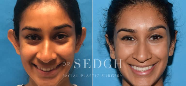 Ear Pinning Surgery Before and After Photos | Dr. Sedgh