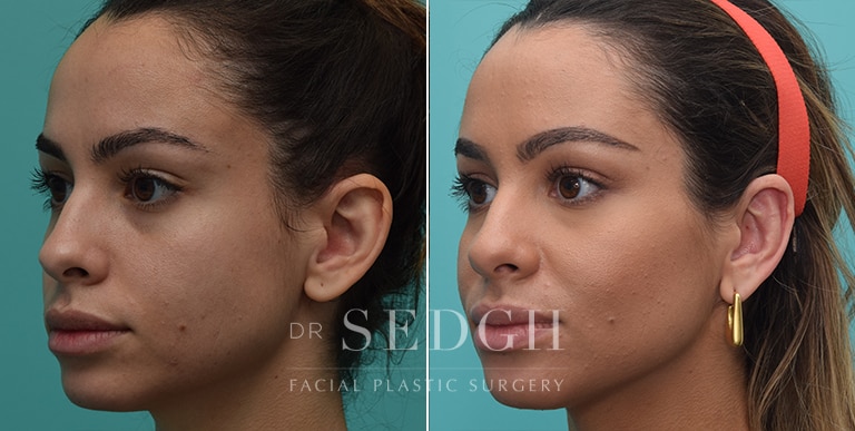 Ear Pinning Surgery Before and After Photos | Dr. Sedgh
