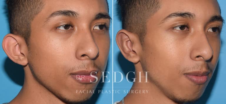 Ear Pinning Surgery Before and After Photos | Dr. Sedgh