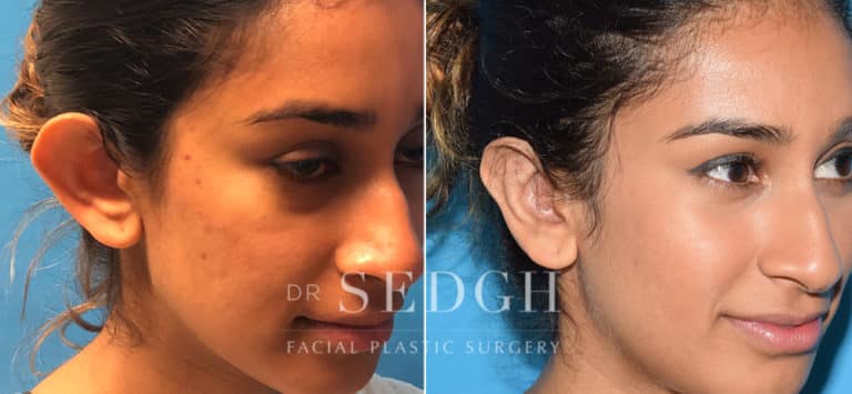 Ear Pinning Surgery Before and After Photos | Dr. Sedgh
