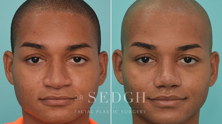 Lips Plastic Surgery Before And After | Lipstutorial.org