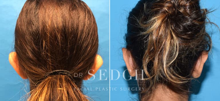 Ear Pinning Surgery Before and After Photos | Dr. Sedgh