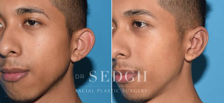 Ear Pinning Surgery Before and After Photos | Dr. Sedgh
