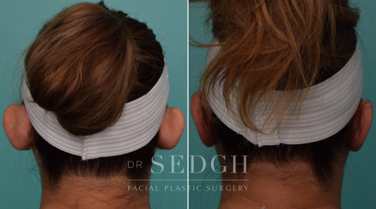 Ear Pinning Surgery Before and After Photos | Dr. Sedgh