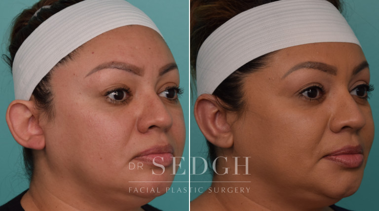 Ear Pinning Surgery Before and After Photos | Dr. Sedgh