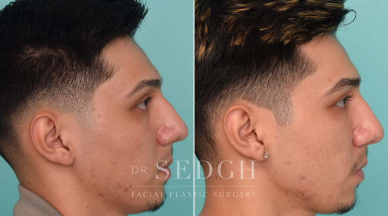 Ear Pinning Surgery Before and After Photos | Dr. Sedgh