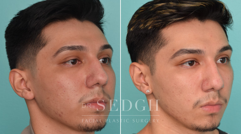 Ear Pinning Surgery Before and After Photos | Dr. Sedgh