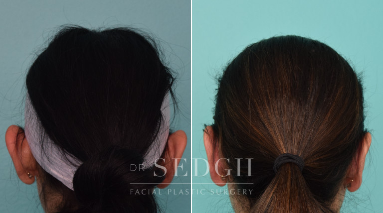 Ear Pinning Surgery Before and After Photos | Dr. Sedgh