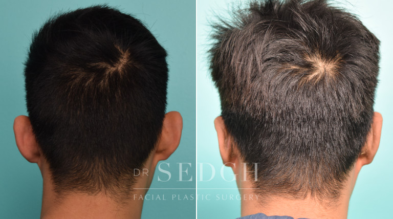 Ear Pinning Surgery Before and After Photos | Dr. Sedgh