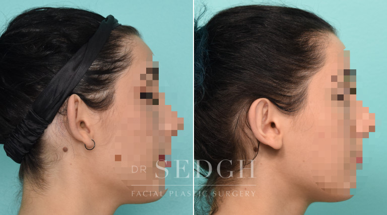 Otoplasty Recovery