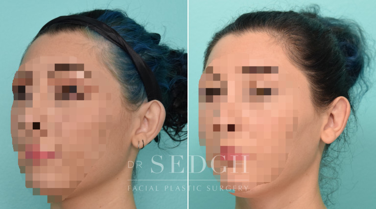 Ear Pinning Surgery Before and After Photos | Dr. Sedgh