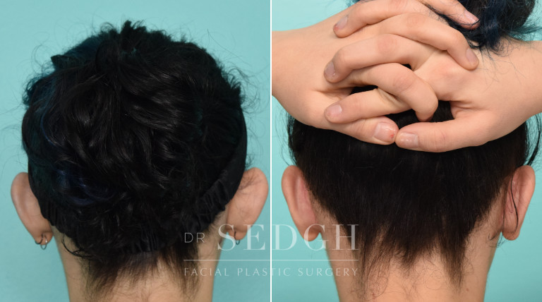 Ear Pinning Surgery Before and After Photos | Dr. Sedgh