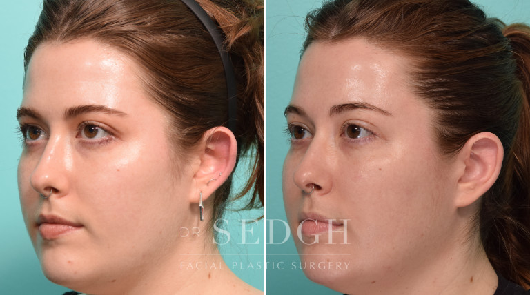 Ear Pinning Surgery Before and After Photos | Dr. Sedgh