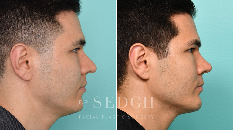 Male Rhinoplasty Before & After Photos | Dr. Sedgh