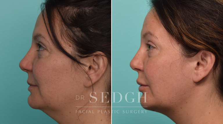 Chin Augmentation Before and After Photos | Dr. Sedgh