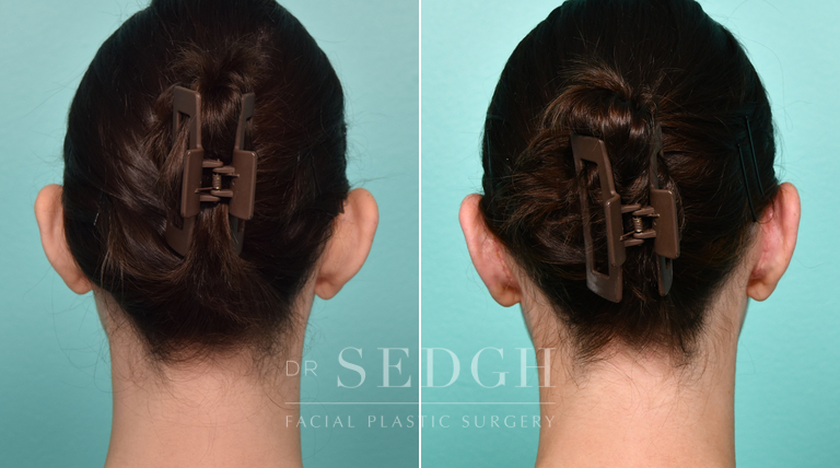 Ear Pinning Surgery Before and After Photos | Dr. Sedgh