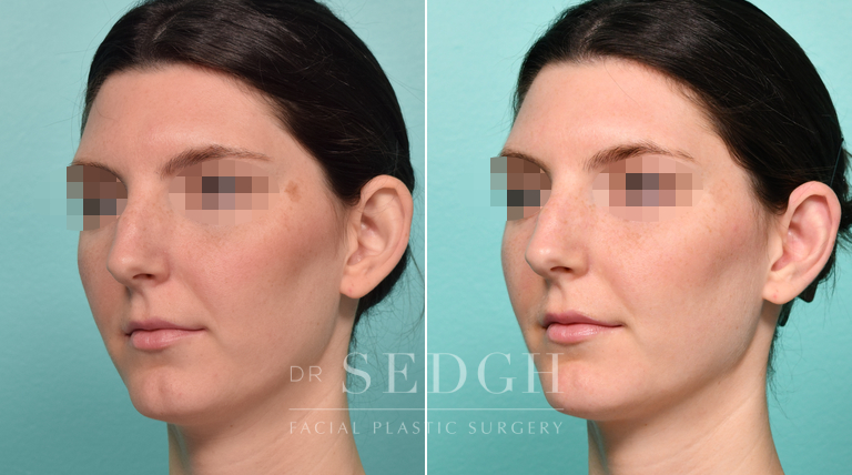 Ear Pinning Surgery Before and After Photos | Dr. Sedgh