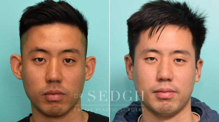 Ear Pinning Surgery Before and After Photos | Dr. Sedgh