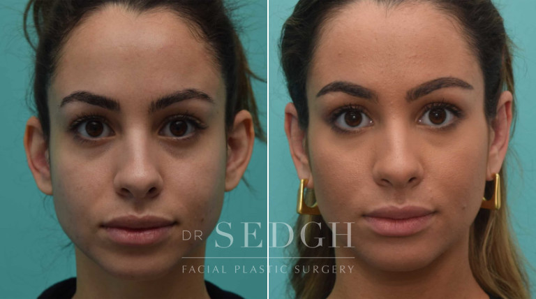 Ear Pinning Surgery Before and After Photos | Dr. Sedgh
