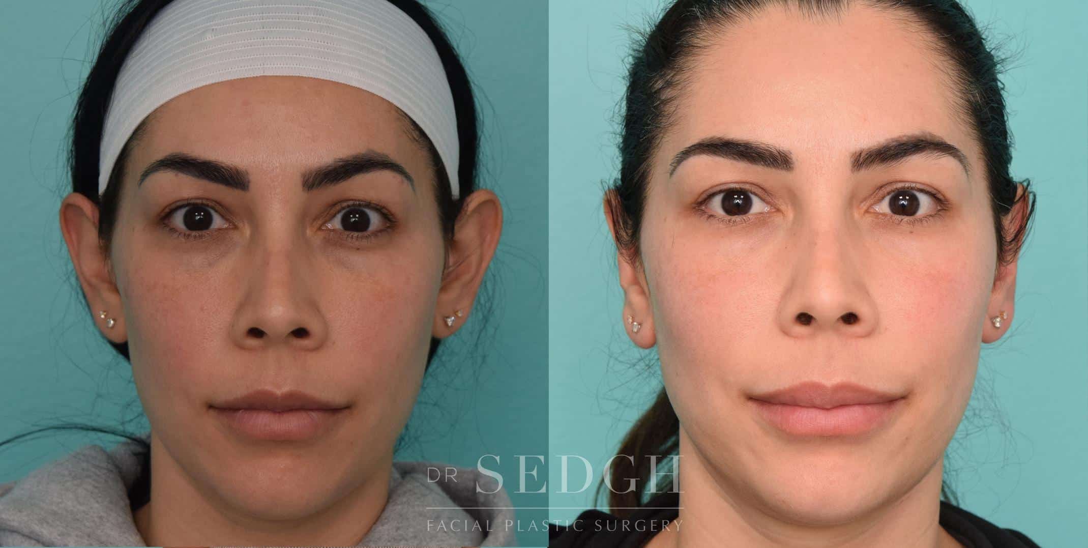 Ear Pinning Surgery Before and After Photos | Dr. Sedgh