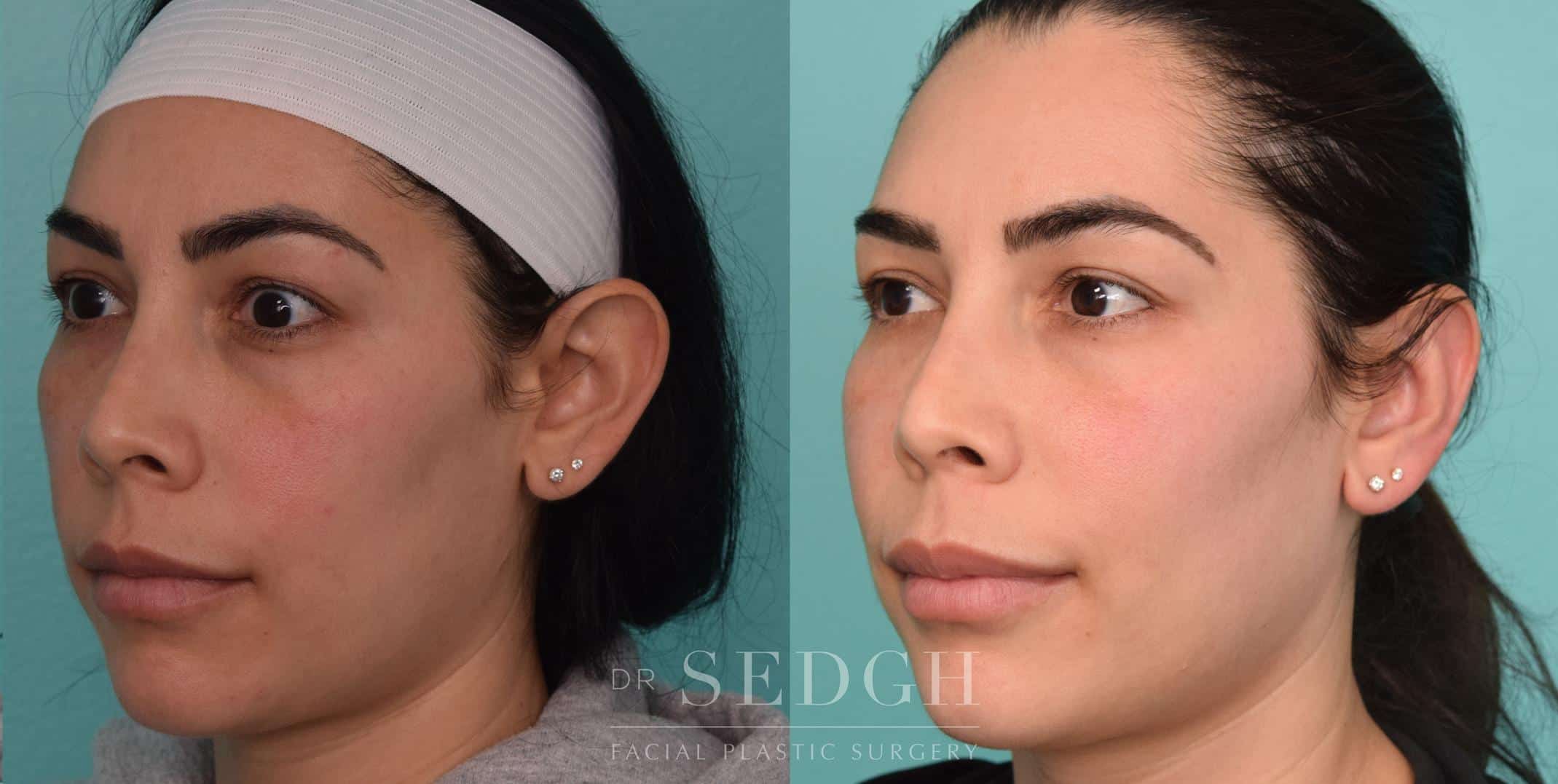 Ear Pinning Surgery Before and After Photos | Dr. Sedgh