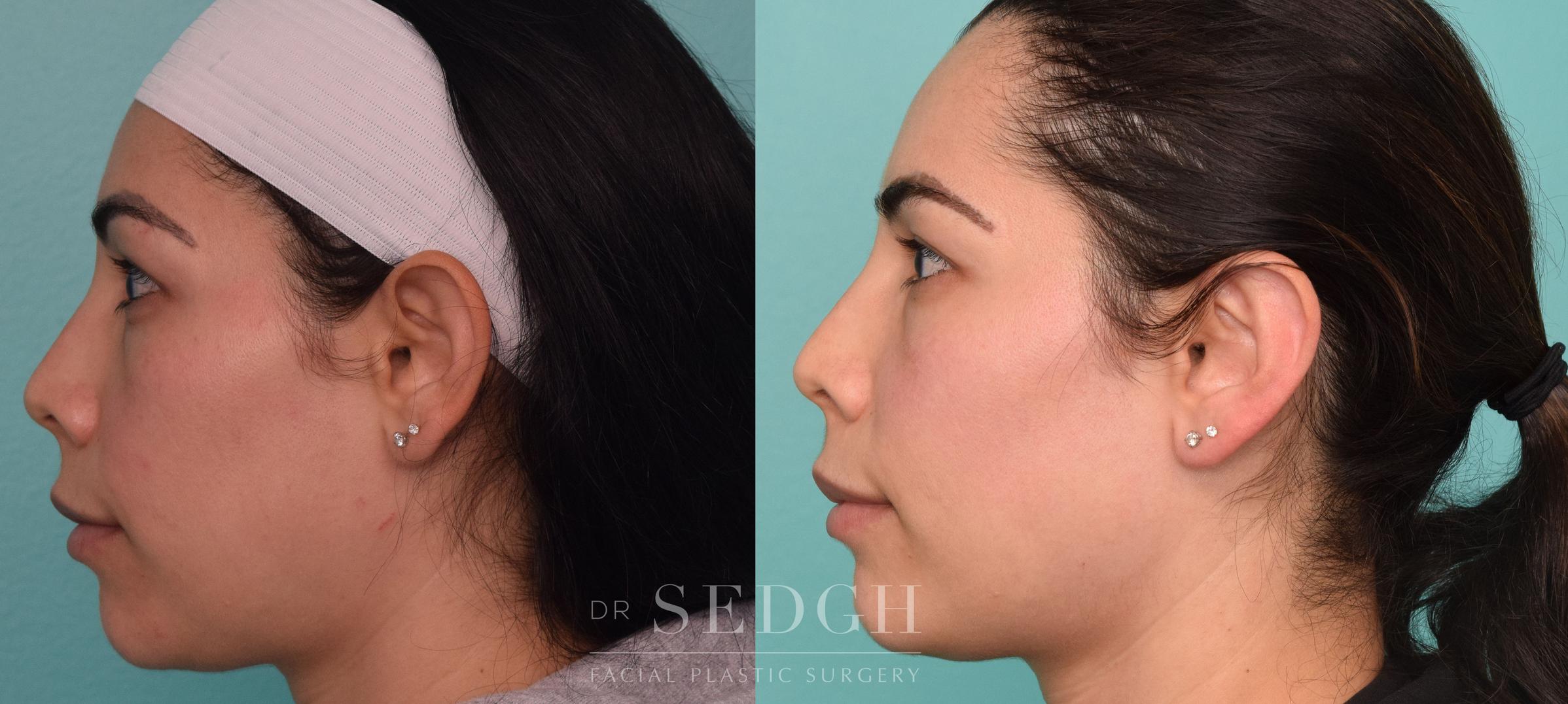 Ear Pinning Surgery Before and After Photos | Dr. Sedgh