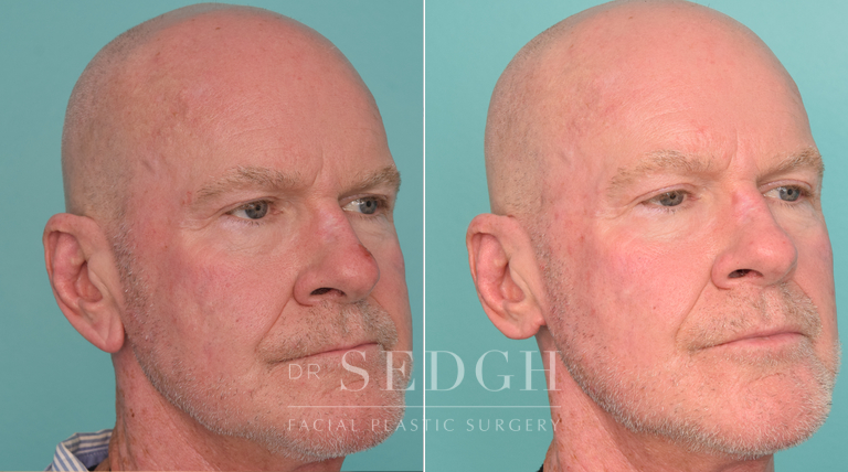 Ear Lobe Reduction Before and After Photos | Dr. Sedgh