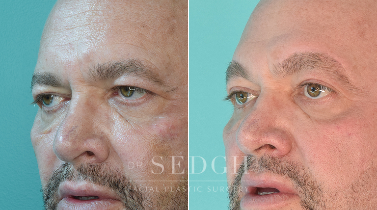 Brow Lift Before and After Photos | Dr. Sedgh