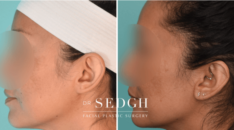 Ear Pinning Surgery Before and After Photos | Dr. Sedgh