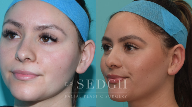 Ear Pinning Surgery Before and After Photos | Dr. Sedgh