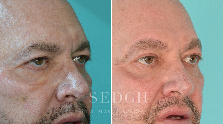 Brow Lift Before and After Photos | Dr. Sedgh