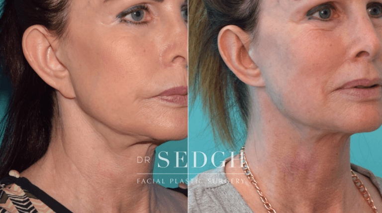 Face Lift Before and After Photos | Dr. Sedgh