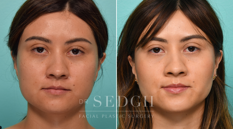 Buccal Fat Reduction Before and After Photos | Dr. Sedgh