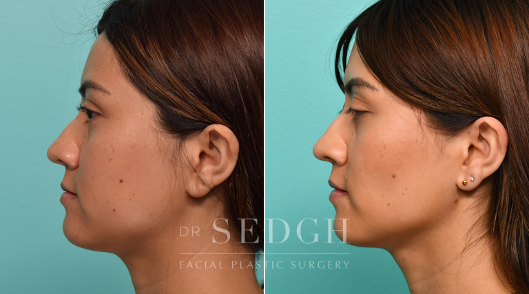 Buccal Fat Reduction Before and After Photos | Dr. Sedgh