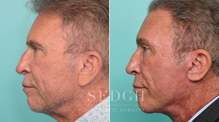 Brow Lift Before and After Photos | Dr. Sedgh